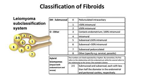 Ppt Uterine Fibroids Powerpoint Presentation Free Download Id 5612276
