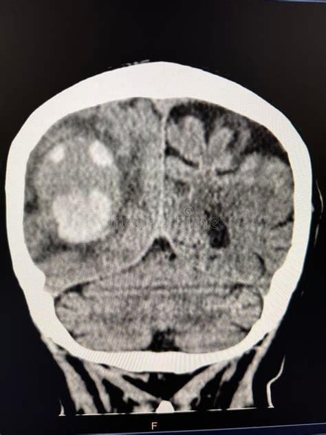Ct Scan With Possible Brain Tumor Stock Image Image Of Identification