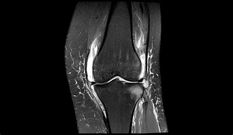 Knee Synovitis Mri Radiology Article On Knee Synovitis