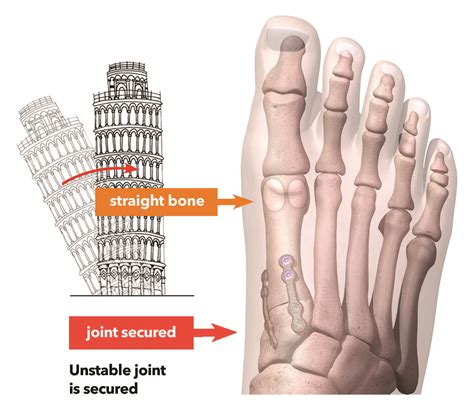Lapiplasty In Portland Or Oregon Foot Clinic