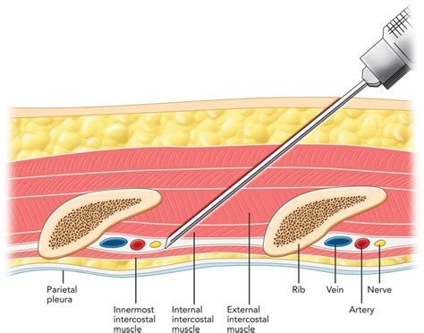Nerve Block Anesthesia Key