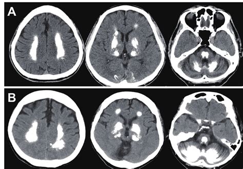 Brain Ct Of The Patients Younger Brother A And The Patient B