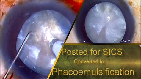 Posted For Manual Sics And Converted To Phacoemulsification Youtube