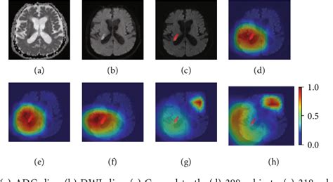 Figure 6 From Deep Learning Based Acute Ischemic Stroke Lesion Segmentation Method On Multimodal