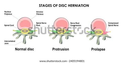 Difference Between Bulging Disc Herniated Disc Stock Illustration Shutterstock