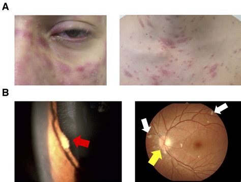Histoplasmosis Skin Rash