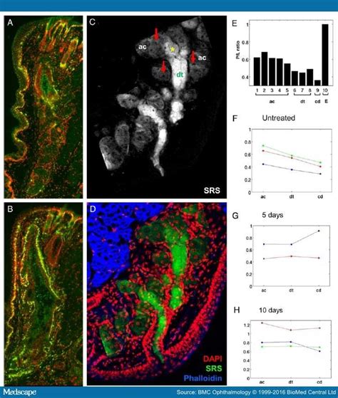 Meibomian Gland Dysfunction Hyperkeratinization Or Atrophy
