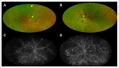 Ocular Syphilis With Phlebitis And Paravenous Pigmentary Retinopathy