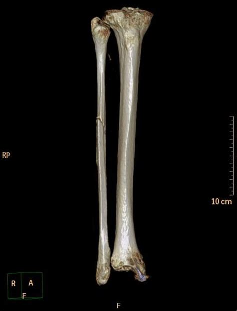 Danis Weber Classification Pacs