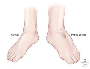 What Is Edema Ashchi Heart And Vascular Center