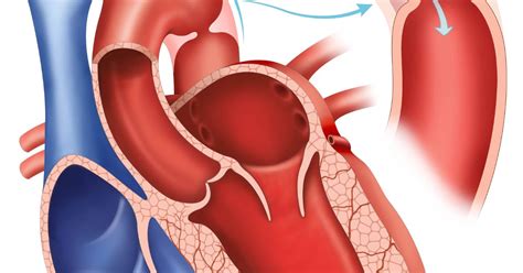Mitral Valve Disease Causes Symptoms Diagnosis And Treatment