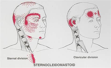 Muscle Pain Massage Humana