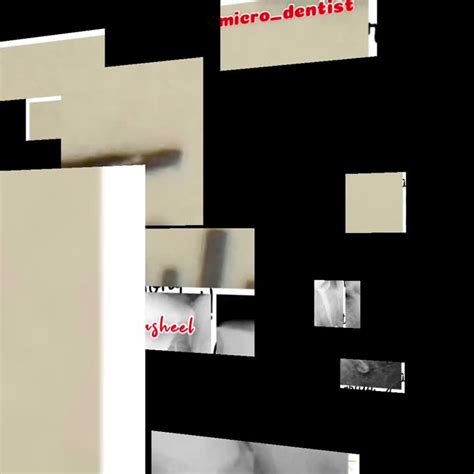 Dr Susheel Kumar On Linkedin Separatedinstrumentremoval Severerootcurvatures