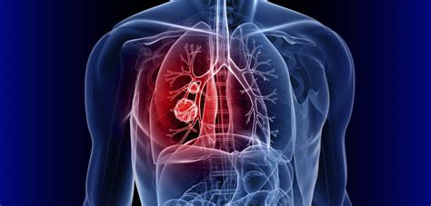 ექსპერიმენტული პრეპარატი რომელიც ფილტვის კიბოს უმძიმეს ფორმას აჩერებს მეცნიერების მორიგი