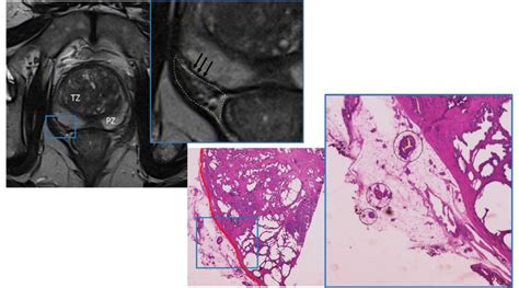 Radio Pathological Correlation Of Normal Prostatic Anatomy T2 Weighted Download Scientific