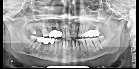 Tooth Instance Segmentation Dataset By Tomasz Derek