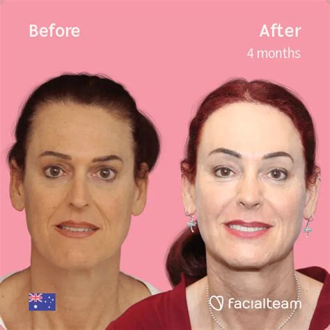Transitioning At A Later Age Is That Even Possible — Facialteam