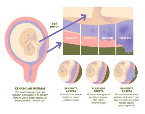 Plasenta Previa Kala Ari Ari Menutupi Jalan Lahir