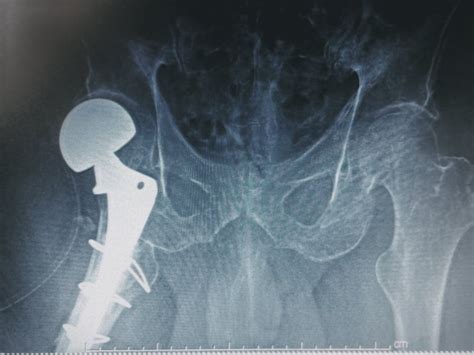 Anyone Want To Guess What Kind Of Hip Precautions They Have R