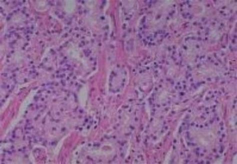 Novus Biologicals Human Prostate Tissue Microarray Cancer Human