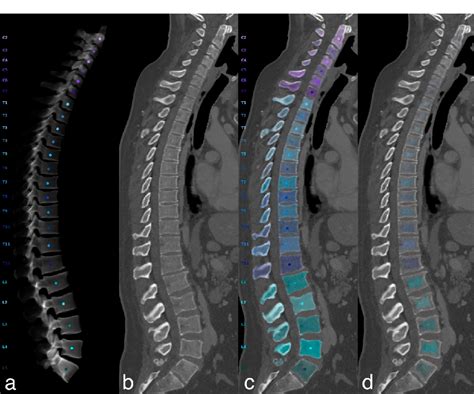 Figure 2 From Automated Opportunistic Trabecular Volumetric Bone Mineral Density Extraction