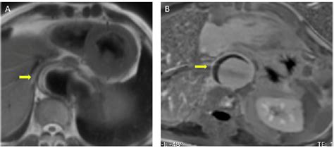 Figure 4 From The Role Of Multimodality Imaging Approach In Acute