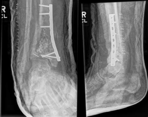 Retrograde Tibia Intramedullary Nailing