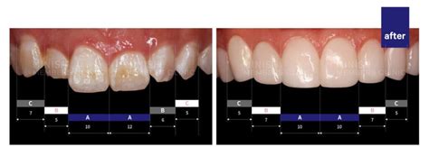 How Can I Get Perfect Teeth Alignment Dasha Taran