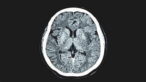 Cat Scan Images