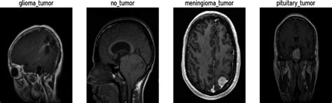 Advancing Brain Tumor Detection Harnessing The Swin Transformers