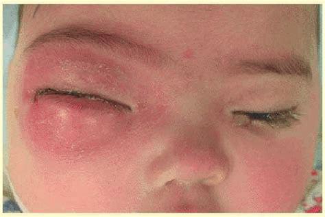 Microbial Preseptal And Orbital Cellulitis Ento Key