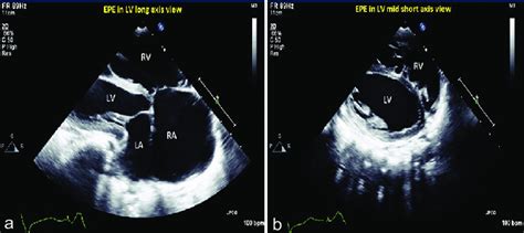 A Epicardial Echocardiography In Lv Long Axis View Showing Dilated Ra