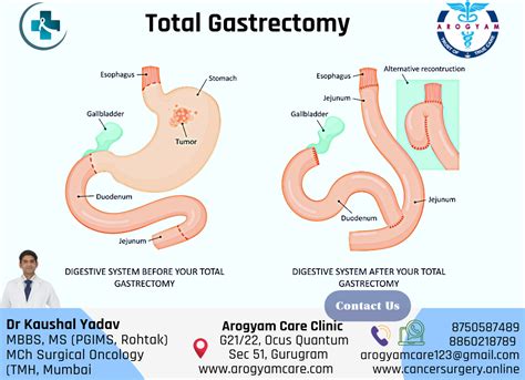 Total Gastrectomy Procedure