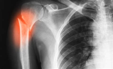 Comminuted Fracture Causes Symptoms And Treatment