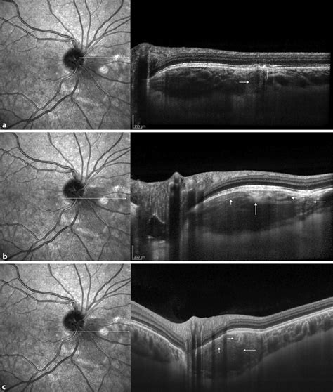 A Enhanced Depth Imaging Optical Coherence Tomography Edi Oct A