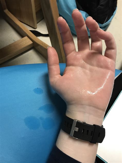 Oh Yeah I Have Sweaty Hands Too Sometimes R Hyperhidrosis