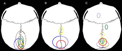 Position Of The Trepanation Holes In The Crania Dotted Lines Possible