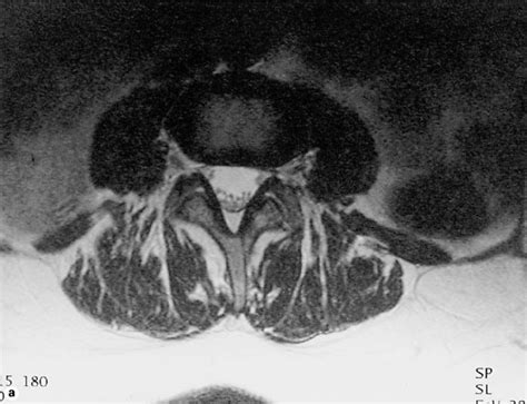 A Mri Showing Normal Lumbar Spi Download Scientific Diagram