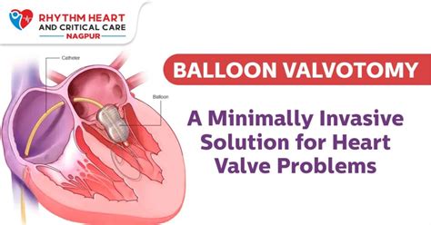 Balloon Valvotomy Blog Rhythm Heart And Critical Care Nagpur