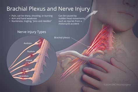 Peripheral Nerve Surgery Department Of Neurosurgery