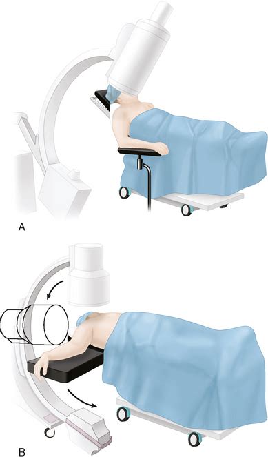 Proximal Humerus Fractures Musculoskeletal Key