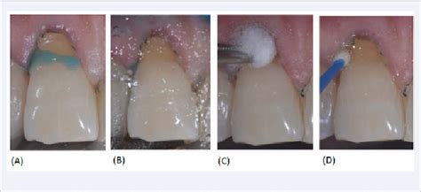 Treatments Of Dental Crown Caries Root Surface Caries And 47 Off
