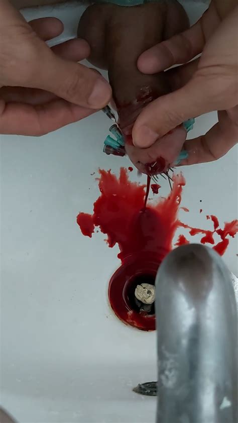 Removing The 20 Needles