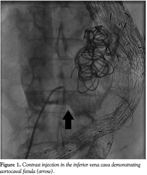 Percutaneous Closure Of Aortocaval Fistula Using The Amplatzer Muscular Vsd Occluder Journal