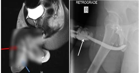 Click And Youre Done Tanzanian Received A Triple Fracture Of The