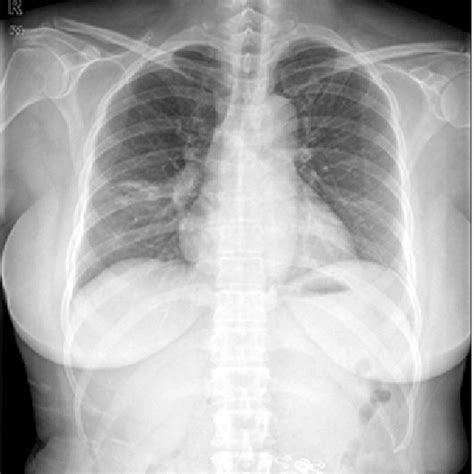 Case 1 Microscopically A The Resected Lung Shows Diffuse Dilated