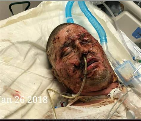 Rd Degree Burn Victims