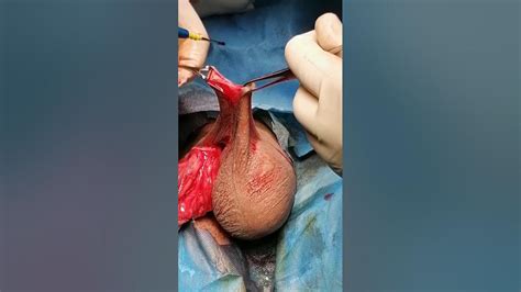 Bilateral Testicular Hydrocelectomy Dr Talib H Al Shawoush Specialist Surgeon Youtube