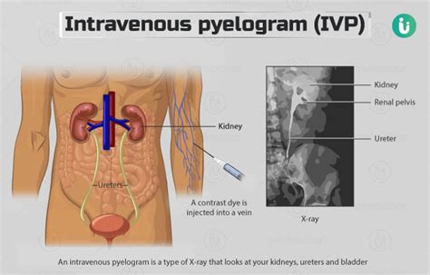 What Is An Intravenous Pyelogram Ivp G U Imaging Ivp Normal