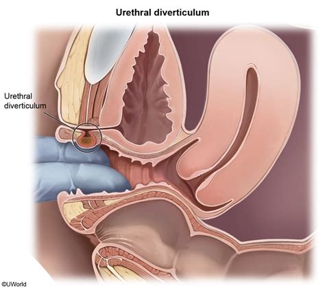 Urethral Diverticulum Gynecology Uworld Medical Library